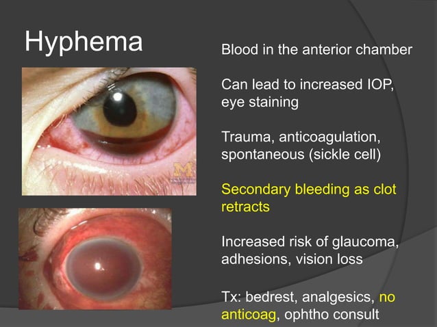 Ophthalmology Board Review- Emergency Medicine 2014 | PPTX | Ear, Nose ...