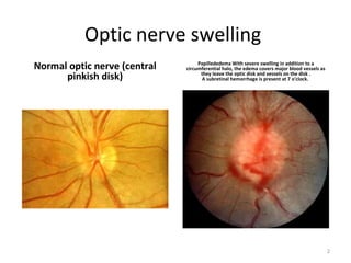 Ophthalmology ospe cc | PPT