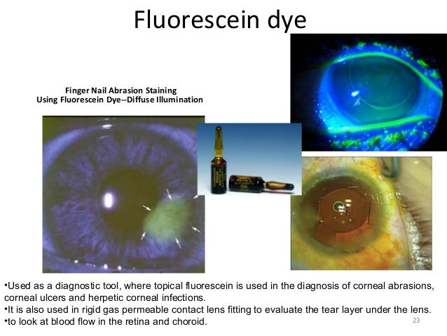 Cpt For Fluorescein Eye Exam Justgoing 2020 Cpt For Fluorescein Eye Exam Justgoing 2020