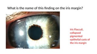 Ophthalmology Photo Quizes # 1 - Miscellaneous.pptx