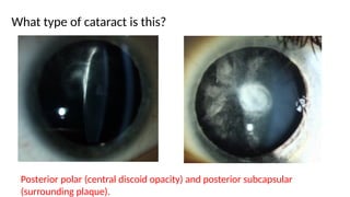Ophthalmology Photo Quizes # Lens and cataract.pptx