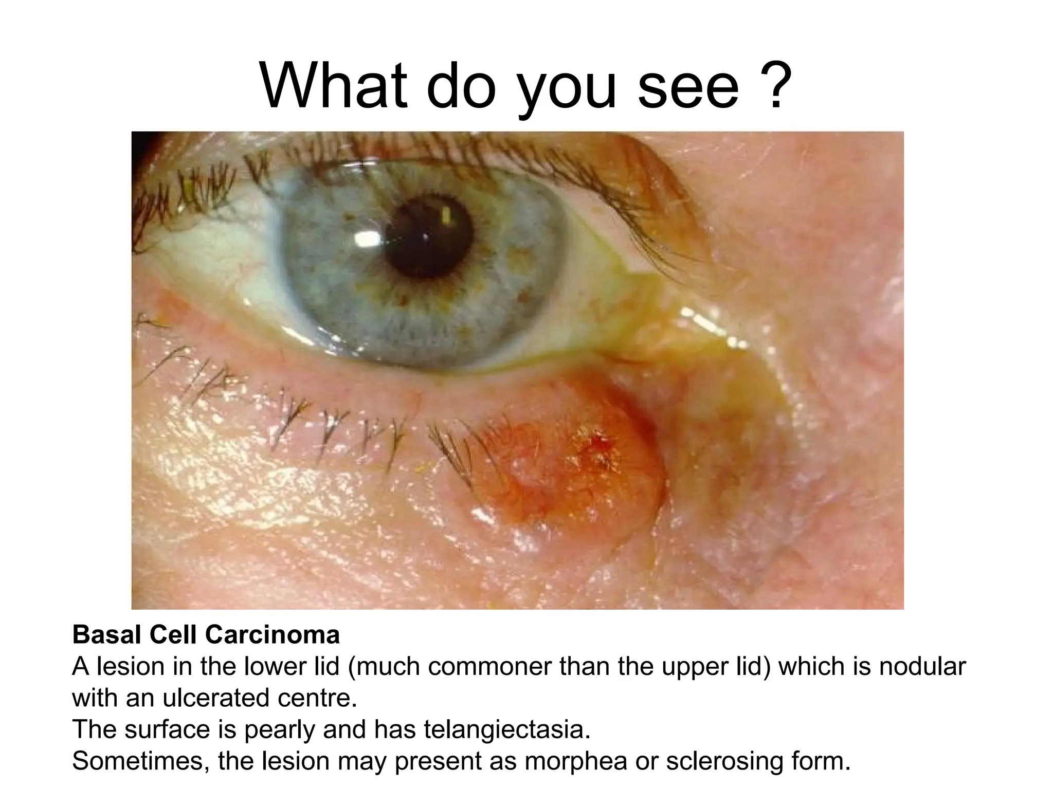 Ophthalmology quick Quiz - Basal Cell Carcinoma.ppt