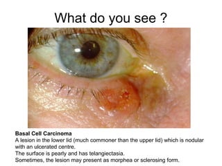 Ophthalmology quick Quiz - Basal Cell Carcinoma.ppt