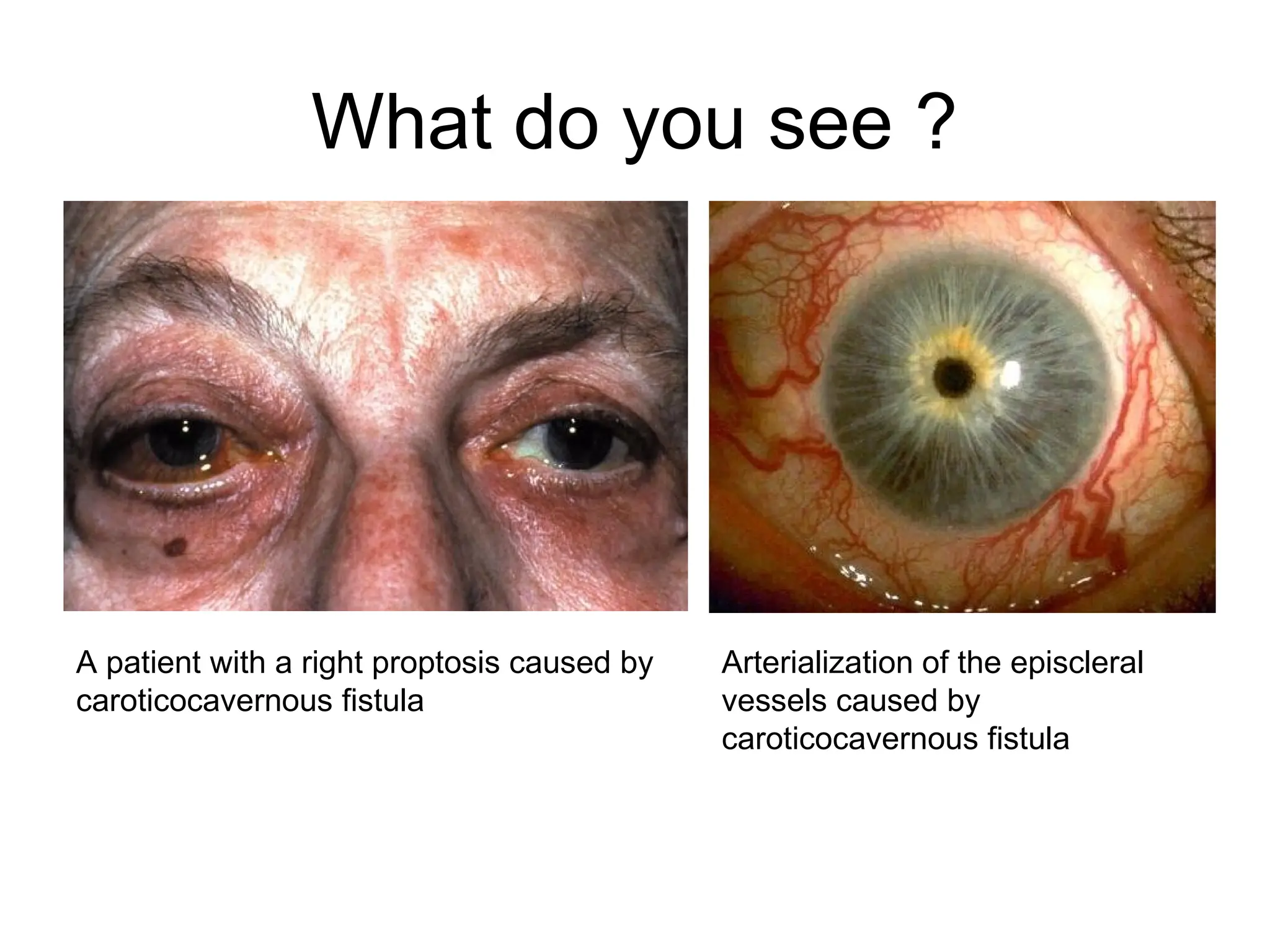Ophthalmology quick Quiz - caroticocavernous fistula.ppt