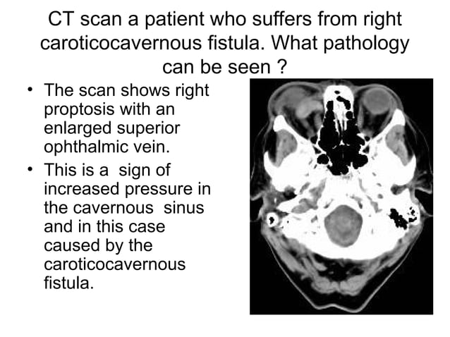 Ophthalmology quick Quiz - caroticocavernous fistula.ppt