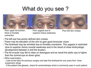 Ophthalmology quick Quiz - congenital ptosis.ppt