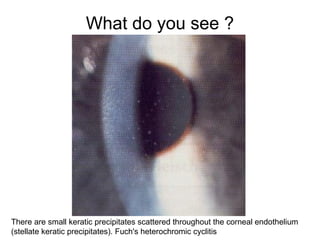 Ophthalmology quick Quiz - fuchs heterochromic cyclitis.ppt