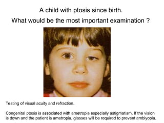 Ophthalmology quick Quiz - Ptosis Riyad Banayot.ppt
