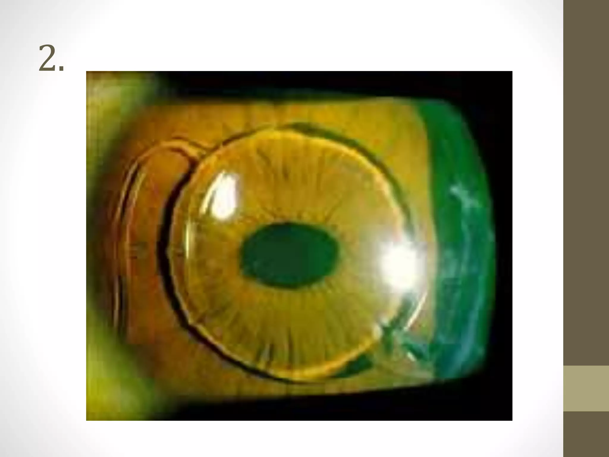 Ophthalmology revision | PPTX