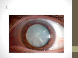 Ophthalmology revision | PPTX