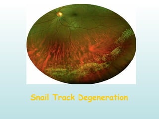 Snail Track Degeneration