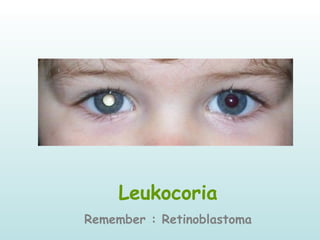 Ophthalmology Signs Around Us III ! | PPT