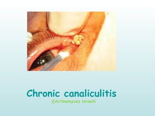 Ophthalmology Signs Around Us III ! | PPT
