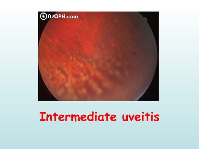 Ophthalmology Signs Around Us III ! | PPT
