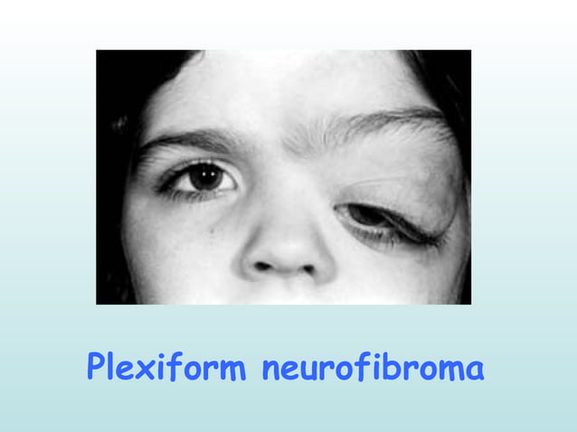 Ophthalmology Signs Around Us III ! | PPT
