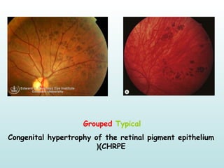 Ophthalmology Signs Around Us ! | PPS