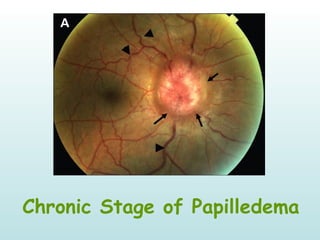 Ophthalmology Signs Around Us ! | PPS