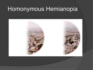 Visual Pathway - Ophthalmology - Eye | PPTX