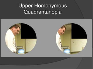 Visual Pathway - Ophthalmology - Eye | PPTX