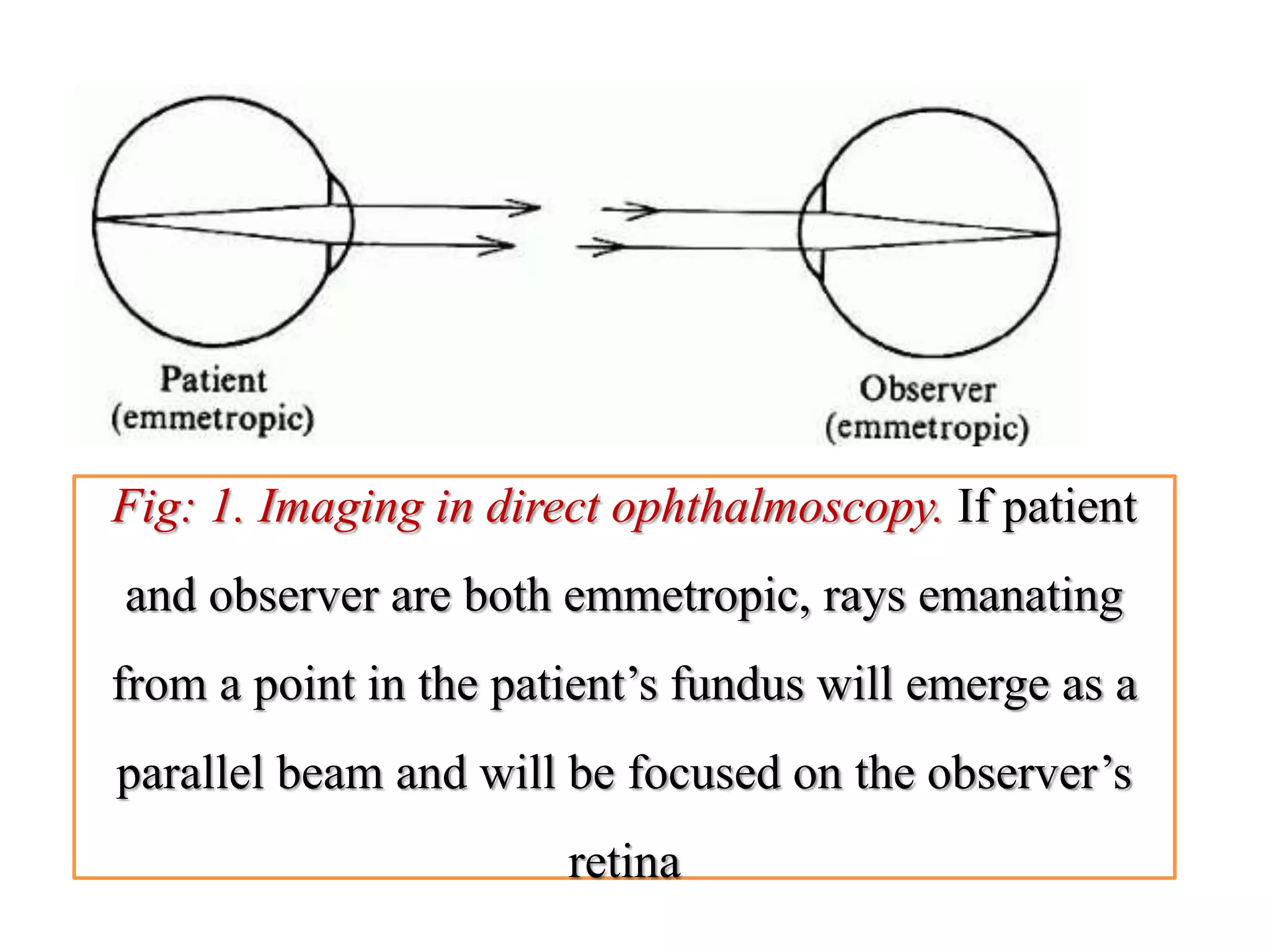 Ophthalmoscope direct and indirect | PPTX
