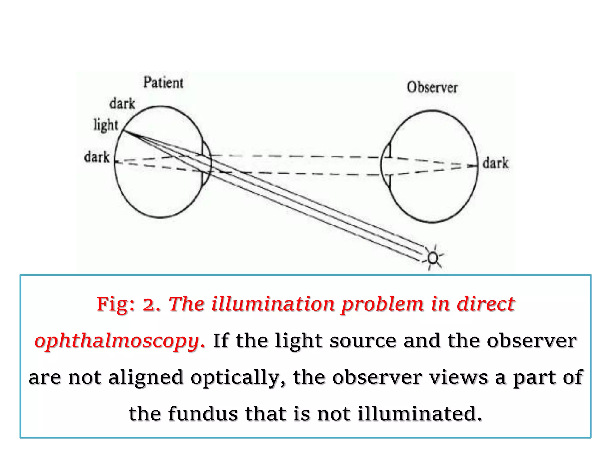 Ophthalmoscope direct and indirect | PPTX