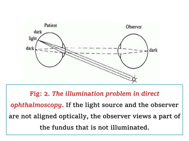 Ophthalmoscope direct and indirect | PPTX | Eye and Vision Conditions ...
