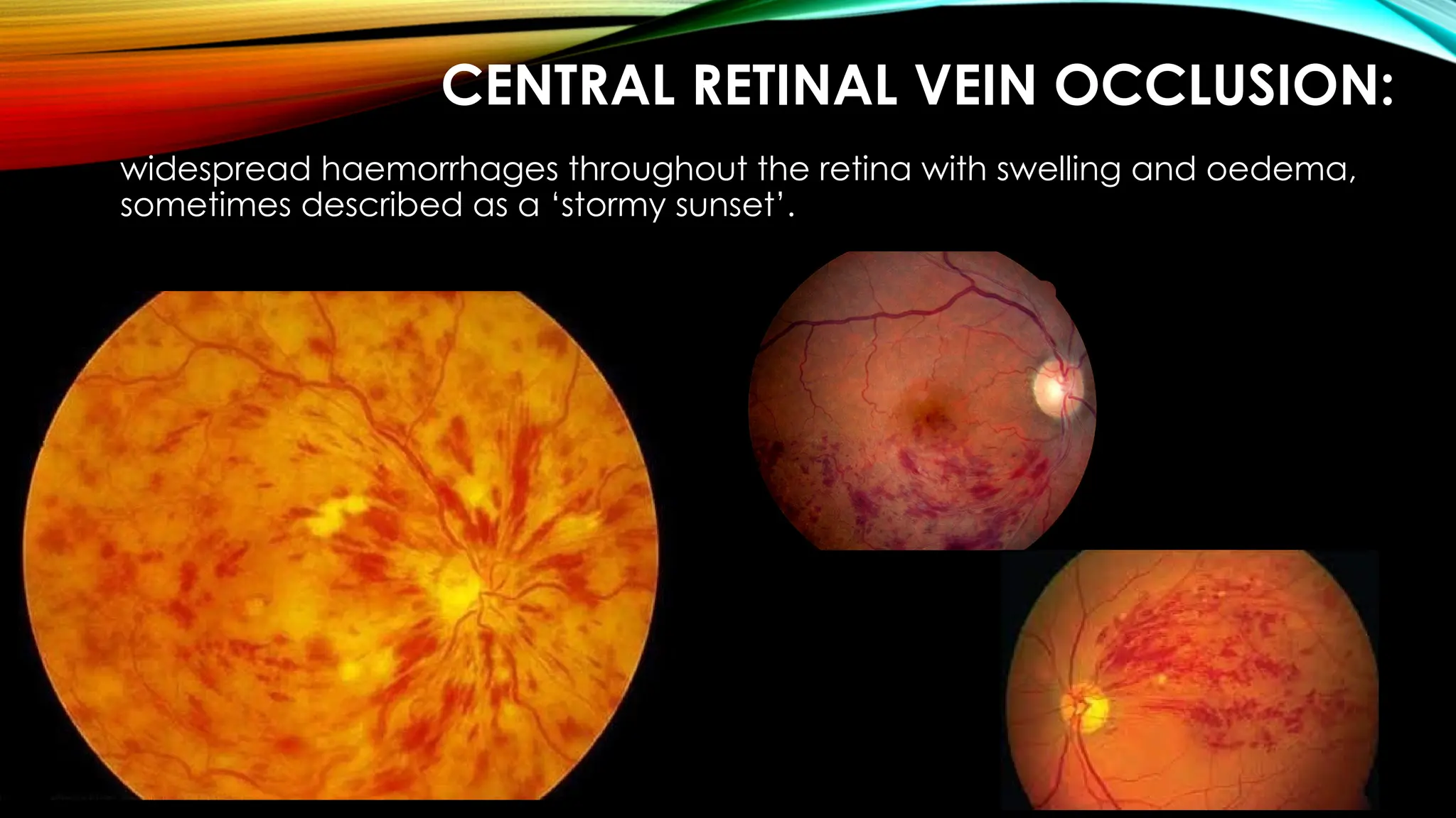 Ophthalmoscopic (Funduscopic) Examination.pptx