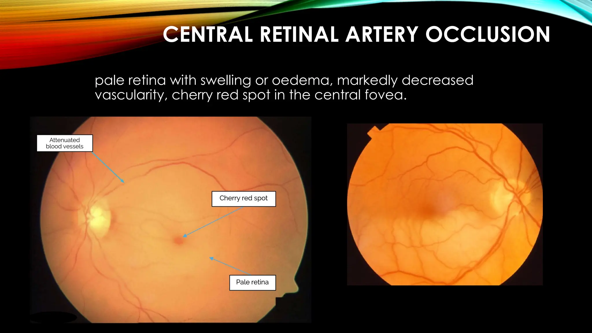 Ophthalmoscopic (Funduscopic) Examination.pptx