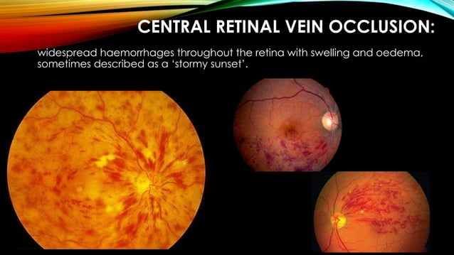 Ophthalmoscopic (Funduscopic) Examination.pptx