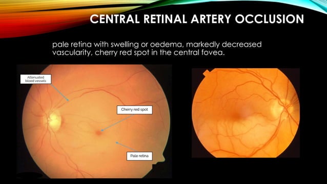 Ophthalmoscopic (Funduscopic) Examination.pptx