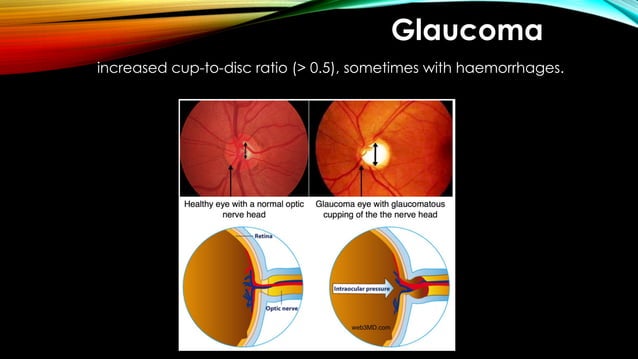 Ophthalmoscopic (Funduscopic) Examination.pptx