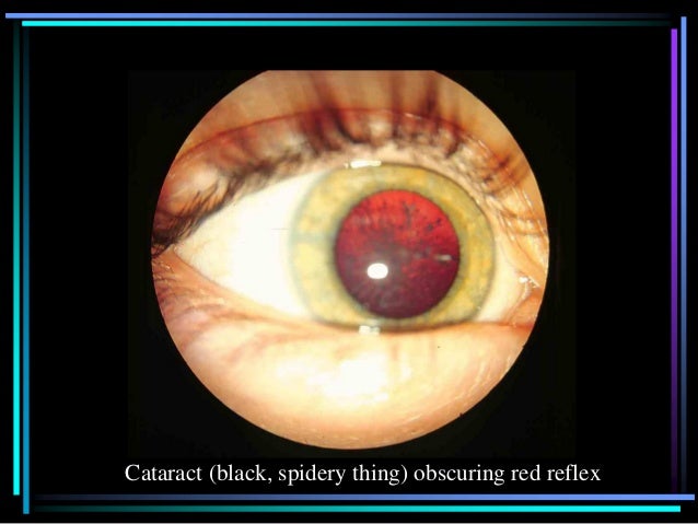 Ophthalmoscopic slides