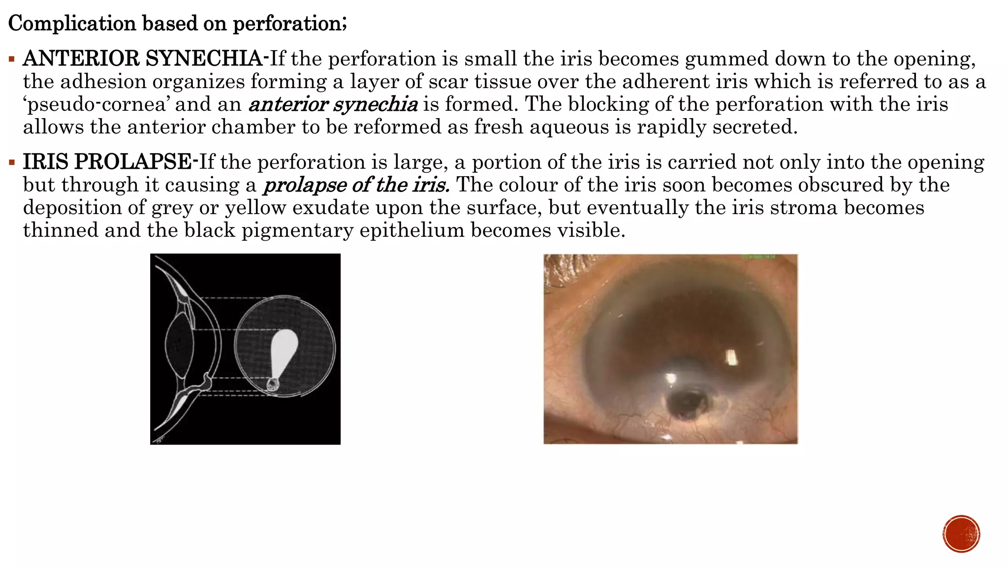 Corneal ulcer | PPTX