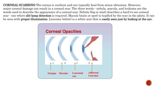 Corneal ulcer | PPTX
