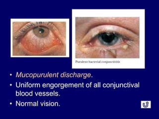 Red eye conjuctivitis & sch | PPT