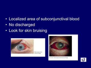 Red eye conjuctivitis & sch | PPT