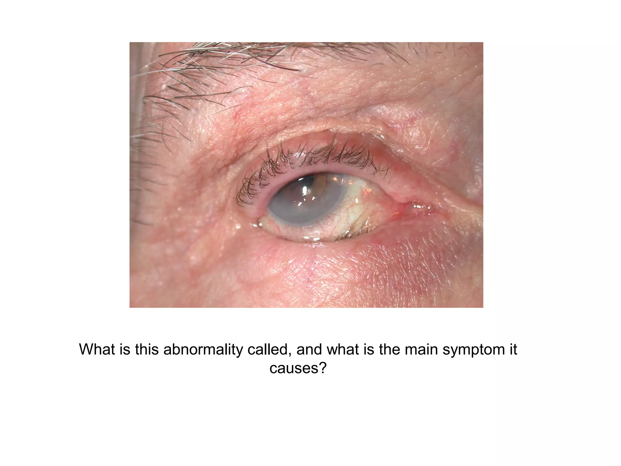 Ophthamology Revision | PPT