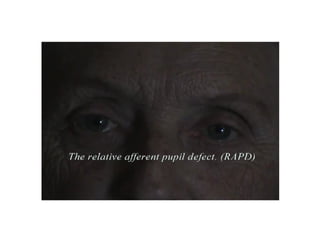 Ophthamology Revision | PPT