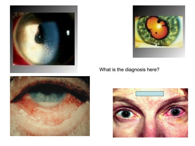 Ophthamology Revision | PPT