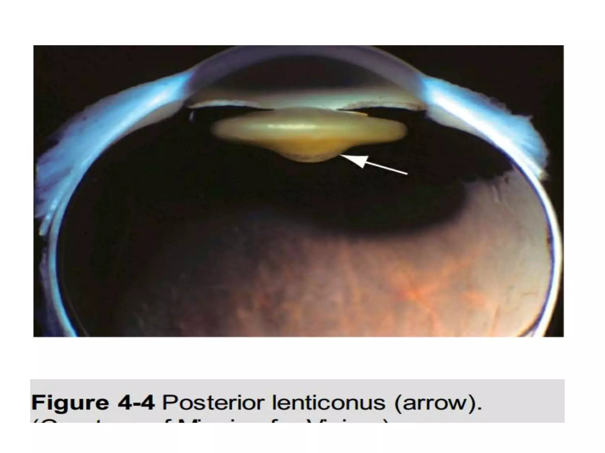 Embryology and developmental defects of lens | PPTX