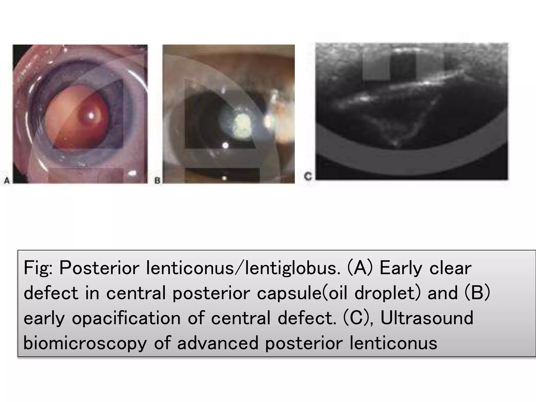 Embryology and developmental defects of lens | PPTX