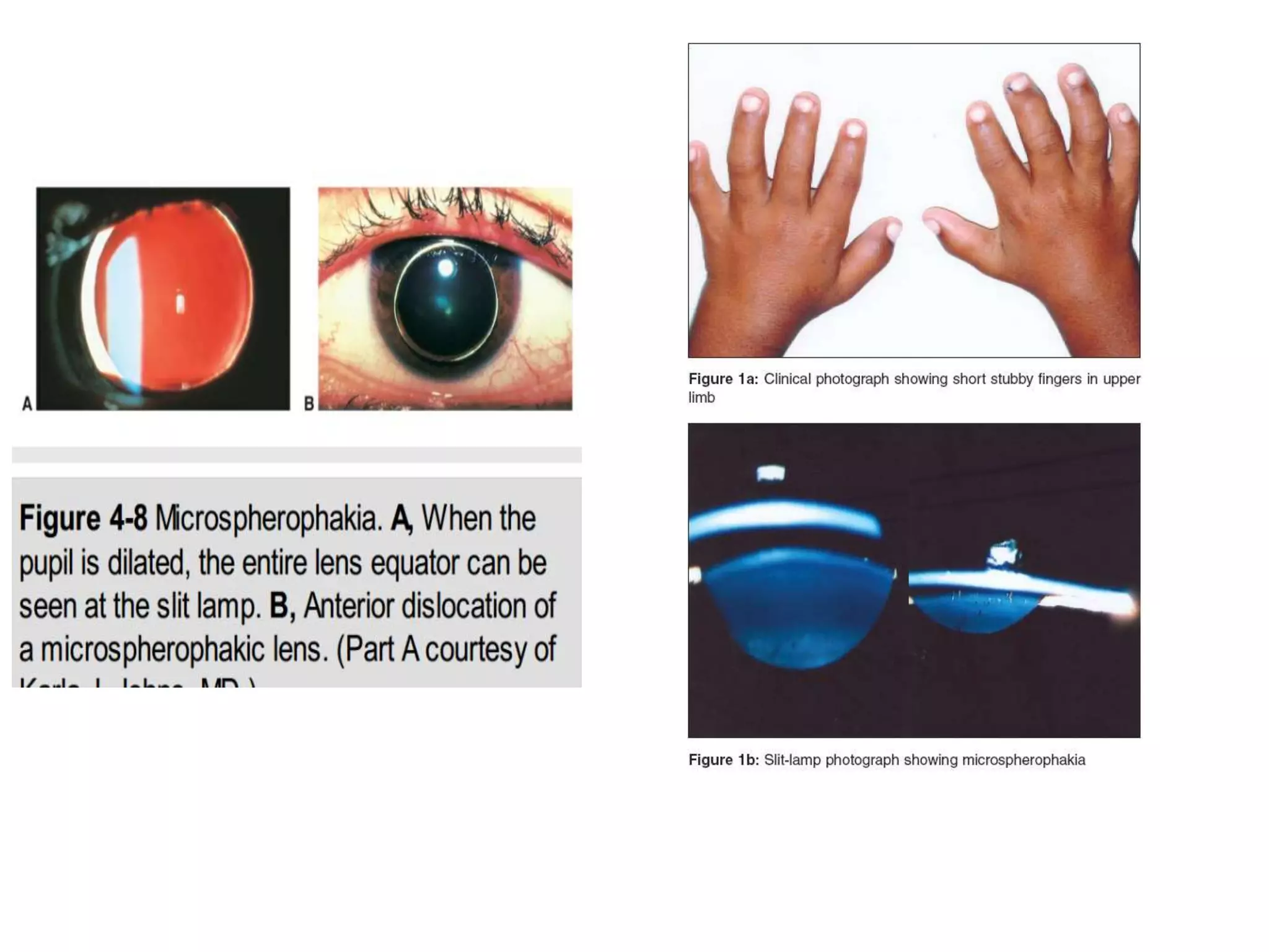 Embryology and developmental defects of lens | PPTX