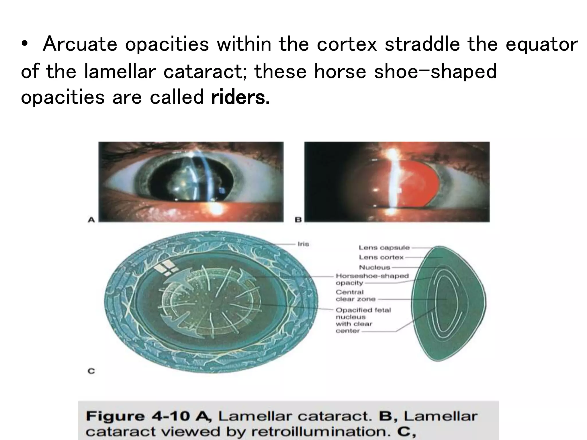 Embryology and developmental defects of lens | PPTX | Eye and Vision ...