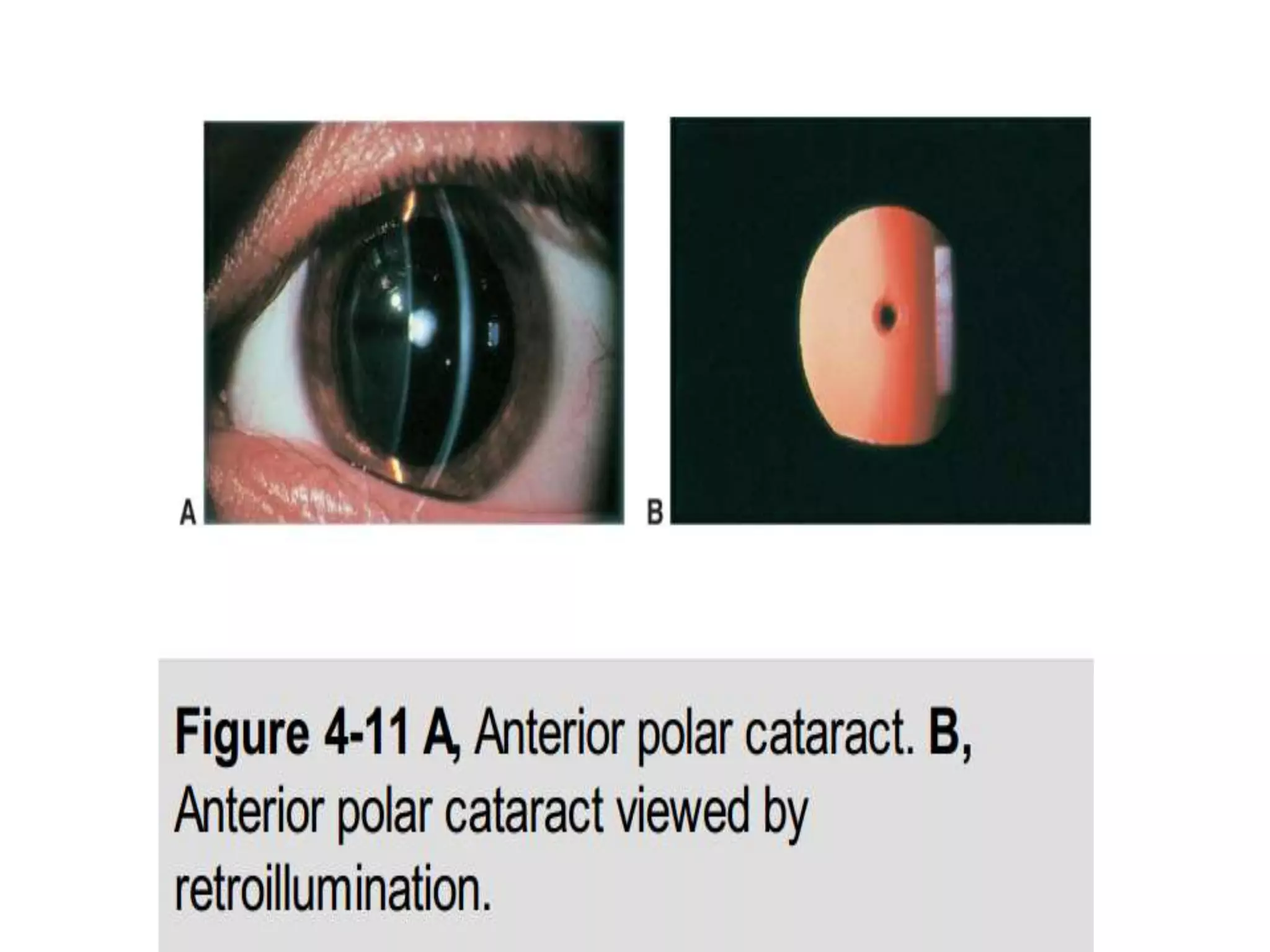 Embryology and developmental defects of lens | PPTX | Eye and Vision ...