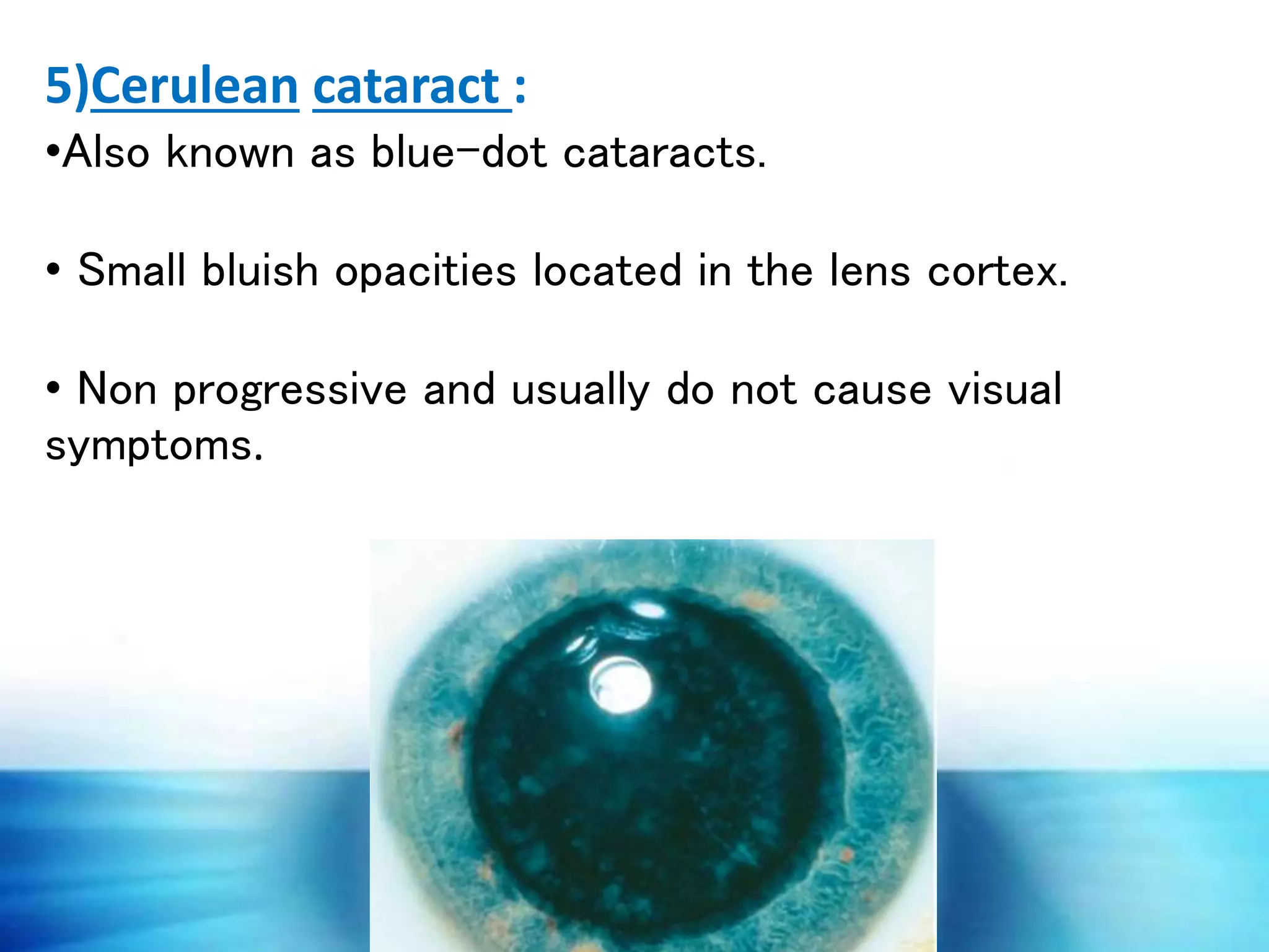 Embryology and developmental defects of lens | PPTX | Eye and Vision ...