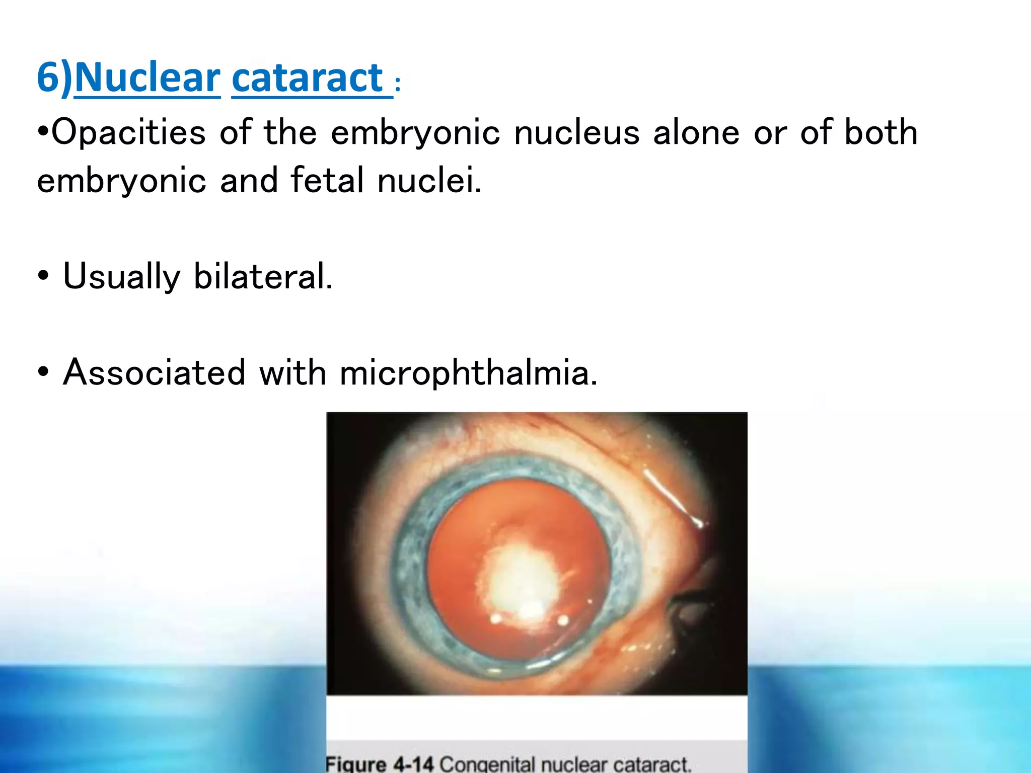 Embryology and developmental defects of lens | PPTX