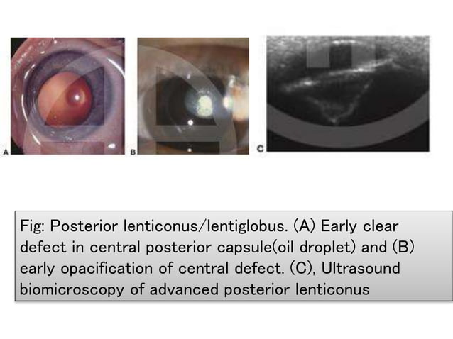Embryology and developmental defects of lens | PPTX | Eye and Vision ...