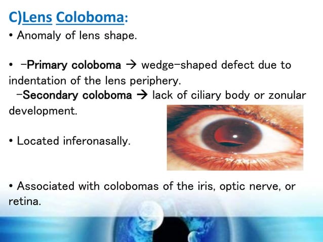 Embryology and developmental defects of lens | PPTX | Eye and Vision ...
