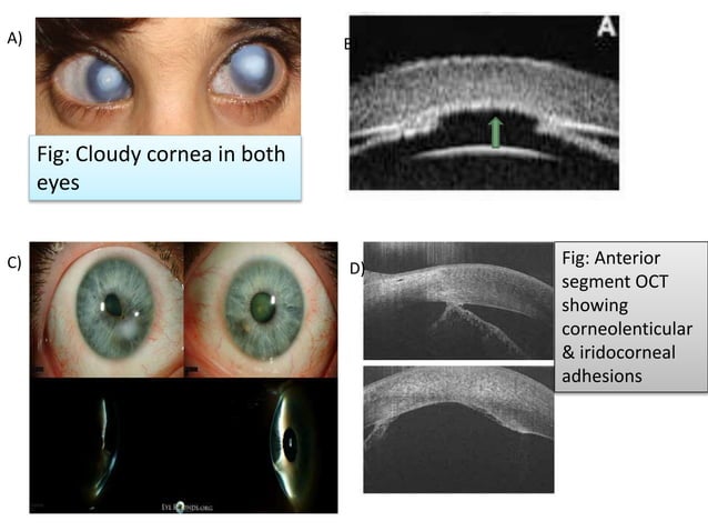 Embryology and developmental defects of lens | PPTX | Eye and Vision ...