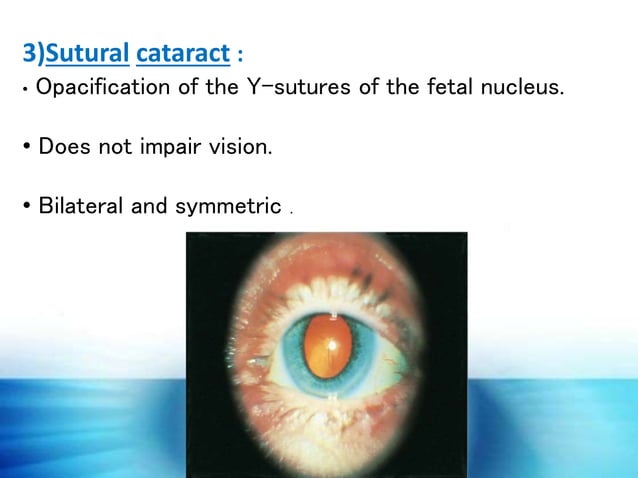 Embryology and developmental defects of lens | PPTX | Eye and Vision ...